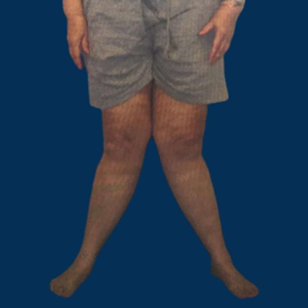 Knock Knee Causes Symptoms Diagnosis And Treatment