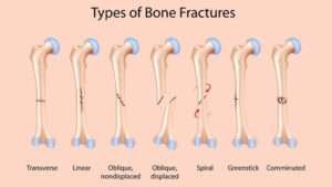 types of bone fractures