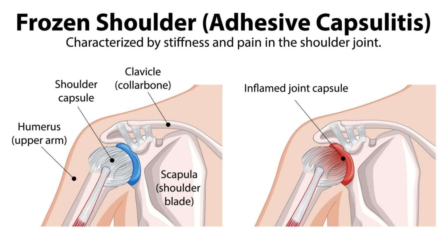 Stages of Frozen Shoulder: Freezing, Frozen & Thawing Phase Explained