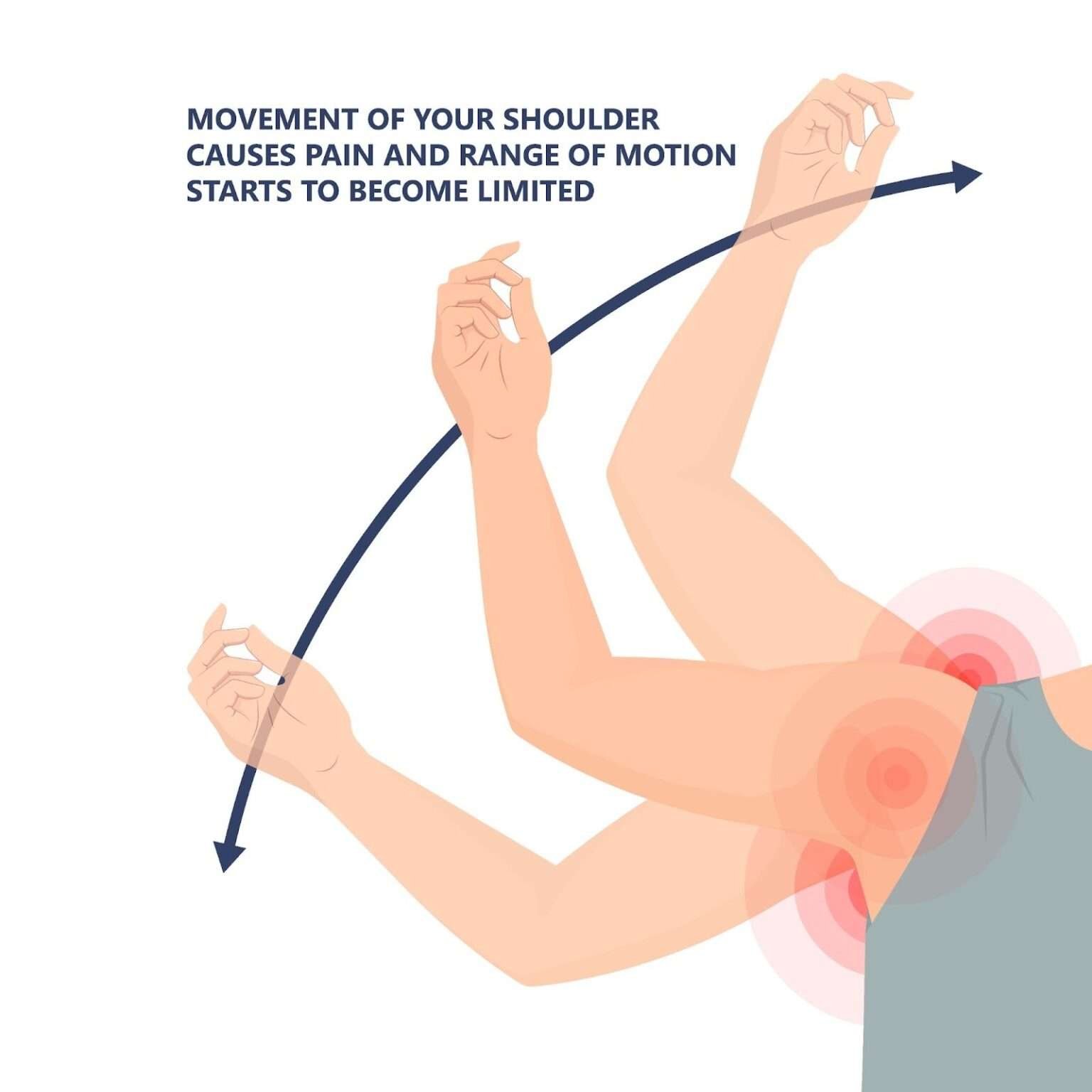 Stages of Frozen Shoulder: Freezing, Frozen & Thawing Phase Explained
